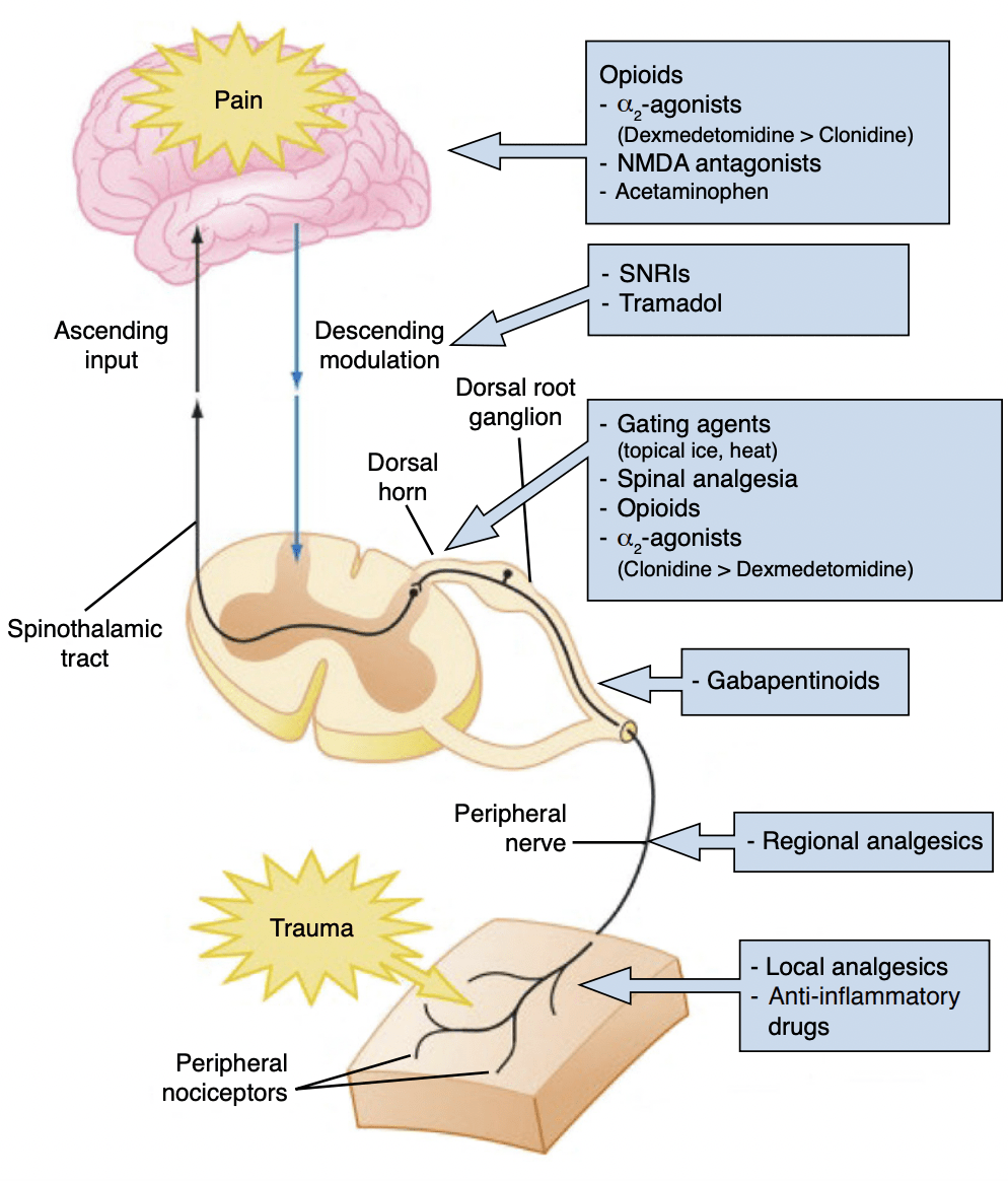 Leitlinie „Acute pain management in trauma patients“ des ACS – FOAMio